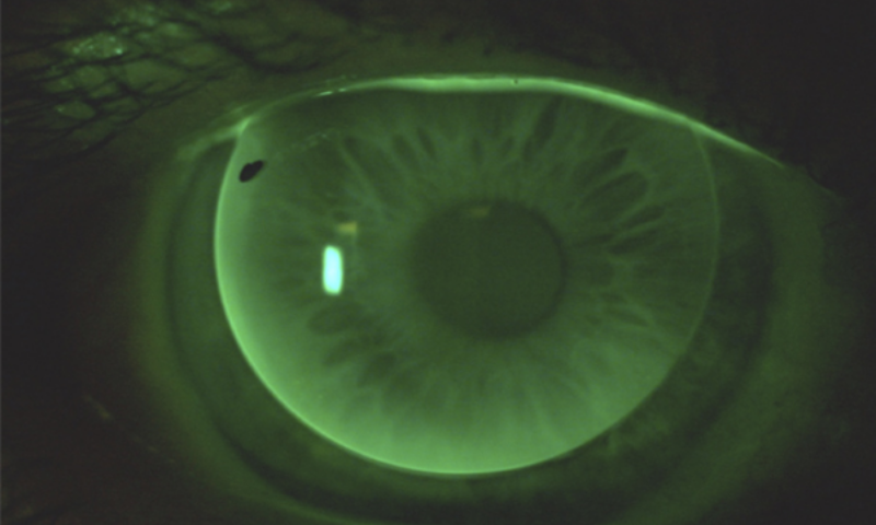 Optic Disc Grading - 2025 | Glaucoma Professional Education Programme